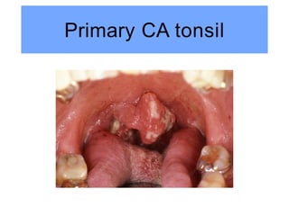Review common pharyngitis march2025 thai | PPT