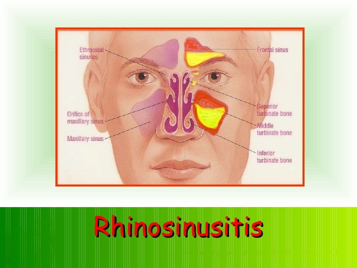 5 rhinitis