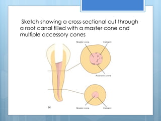 5 root canal filling materials | PPT