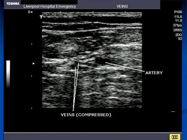 5 scanning for dvt | PDF