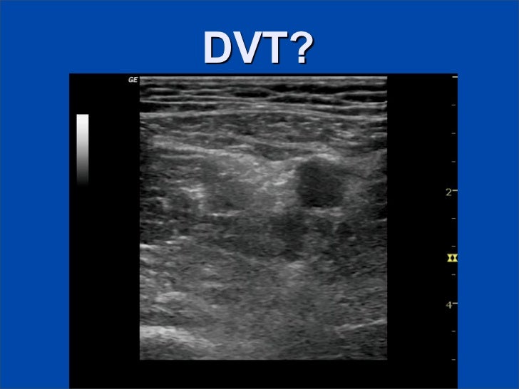 5 scanning for dvt