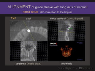 5 single implant case osteotomy prgression in open guide sleeves | PPT