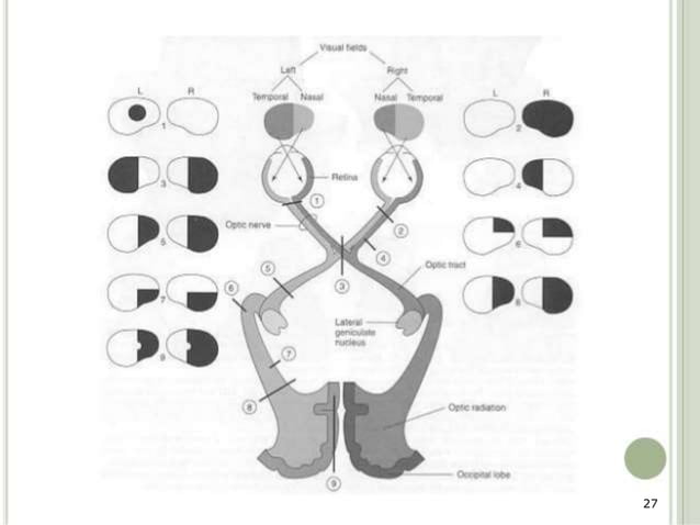 Sistemas Visual Vestibulococlear Y Auditivo Ppt