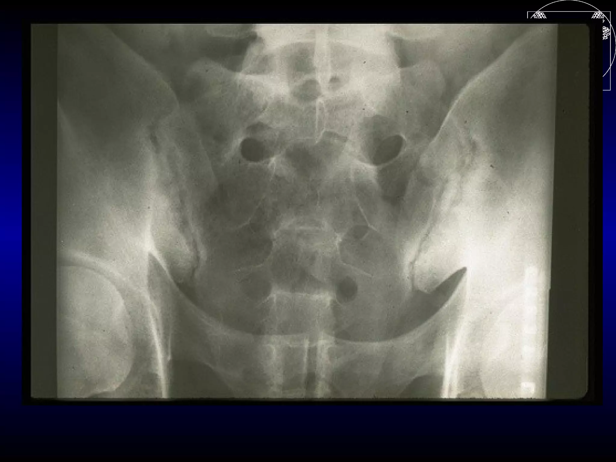 5spondyloarthropaties Seronegative Arthritis | PPT