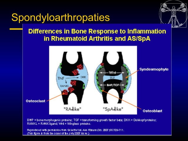 5spondyloarthropaties Seronegative Arthritis | PPT | Physical Therapy ...