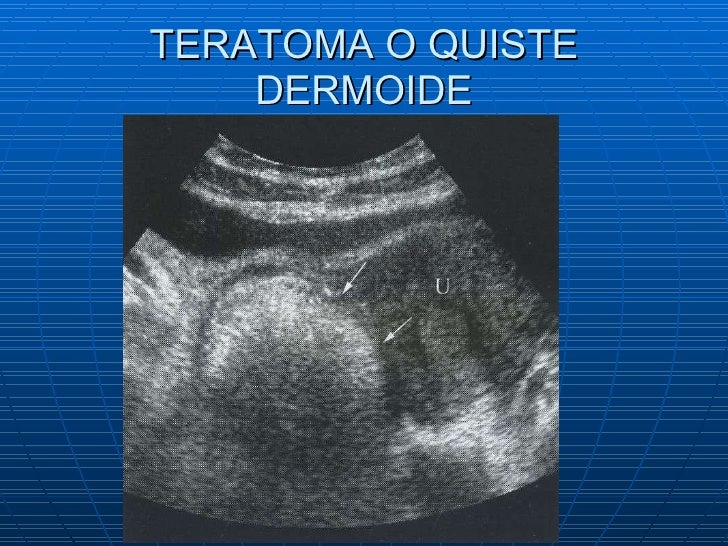 Quiste Dermoide Binipatia E Higienismo