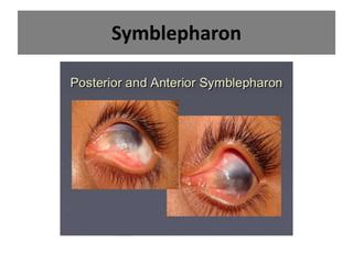 Symblepharon