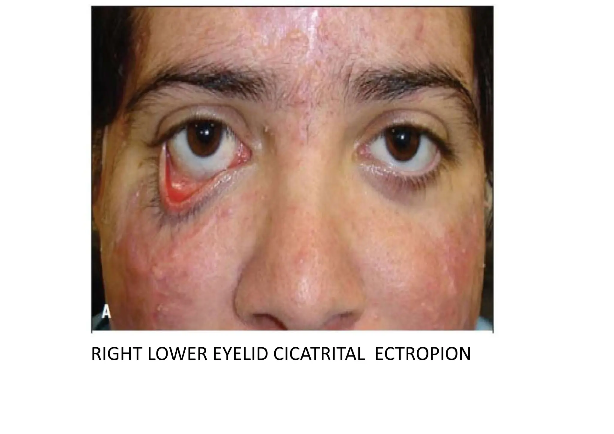 ophthalmology photos for disease and abnormality | PPTX