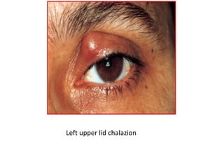 ophthalmology photos for disease and abnormality | PPTX