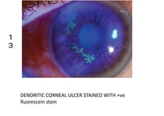 ophthalmology photos for disease and abnormality | PPTX