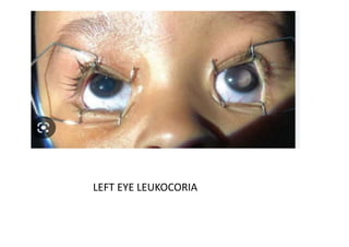 ophthalmology photos for disease and abnormality | PPTX