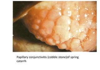 ophthalmology photos for disease and abnormality | PPT