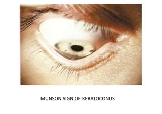 ophthalmology photos for disease and abnormality | PPT