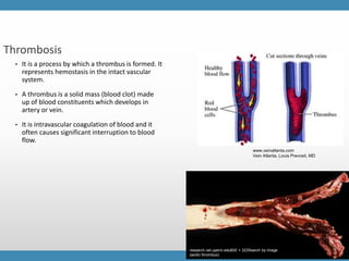 5) Thromboembolism 2021 .ppt presentation | PPT