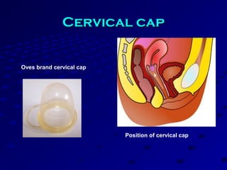 Oves Cervical Caps