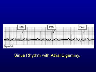 Atrial Quadrigeminy