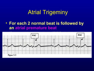 Atrial Quadrigeminy