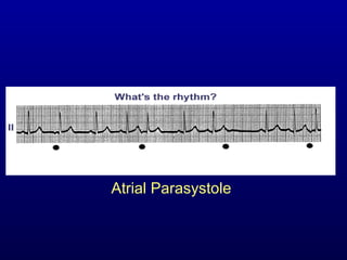 5th part ECG basics: supraventricular arrhythmias Dr Salah Mabrouk ...