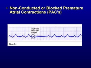 Blocked Premature Atrial Contractions