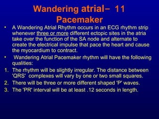 Wandering Atrial Pacemaker Rhythm Strip
