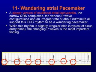 Wandering Atrial Pacemaker Rhythm Strip