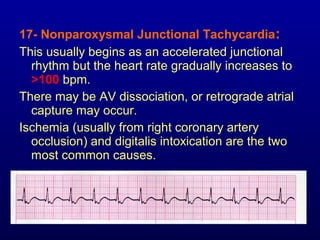 Paroxysmal Junctional Tachycardia