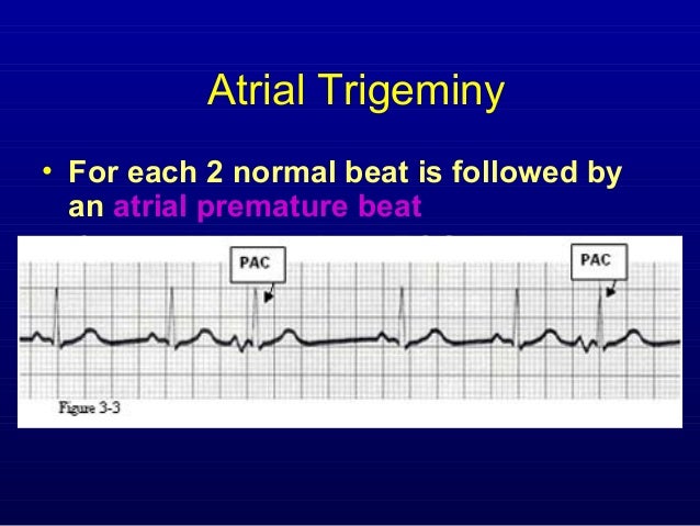 Supraventricular Bigeminy