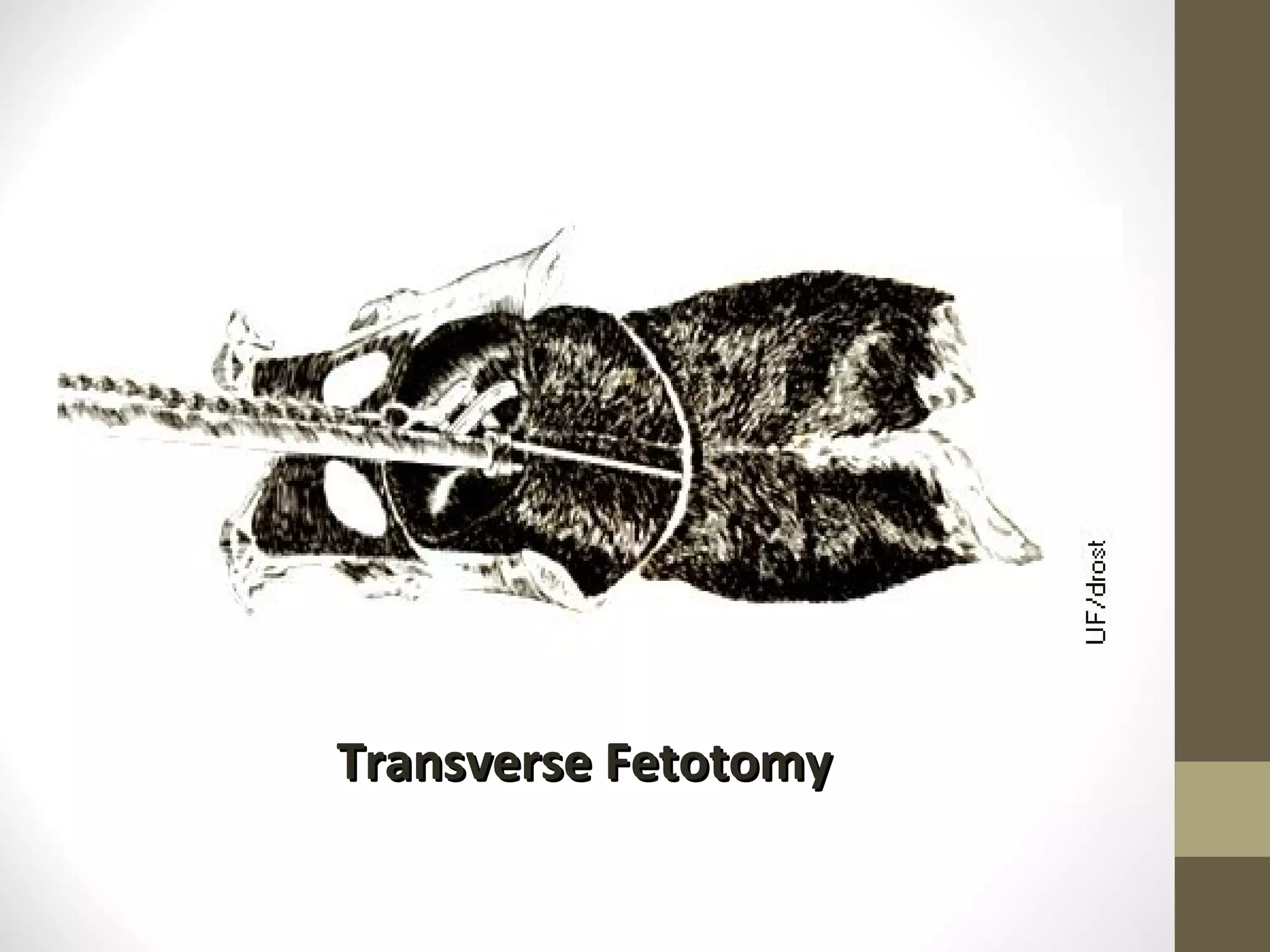 5th year practical revision 7 - fetotomy | PPT