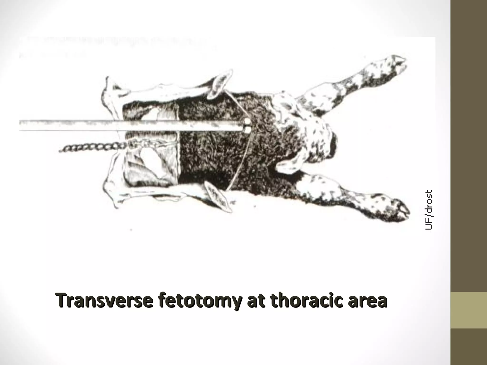 5th year practical revision 7 - fetotomy | PPT