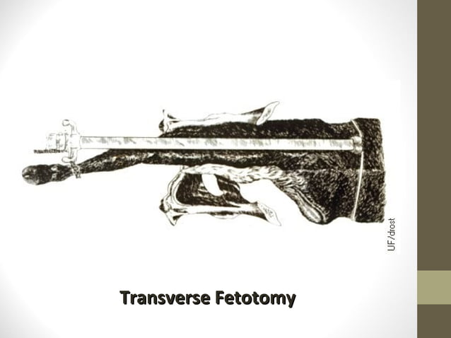 5th year practical revision 7 - fetotomy | PPT