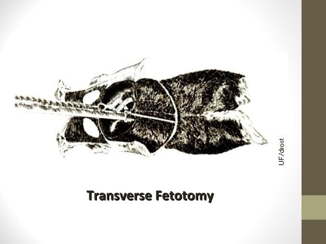 5th year practical revision 7 - fetotomy | PPT