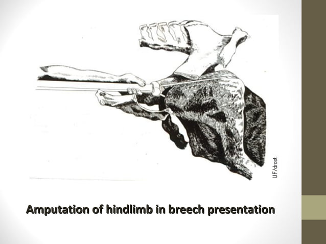 5th year practical revision 7 - fetotomy | PPT