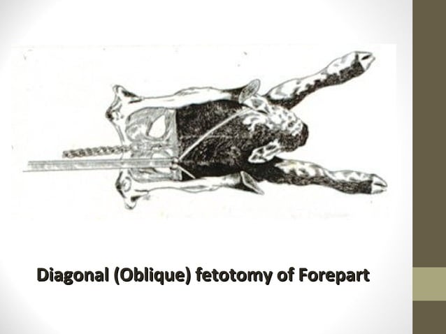 5th year practical revision 7 - fetotomy | PPT