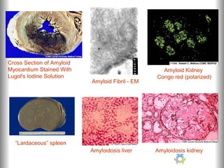 5 Transplant pathology&Amyloidosis.pptmdpath | PPT