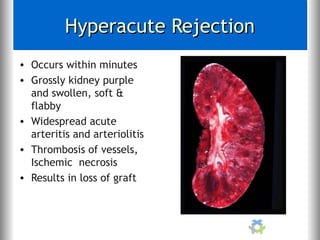 5 Transplant pathology&Amyloidosis.pptmdpath | PPT