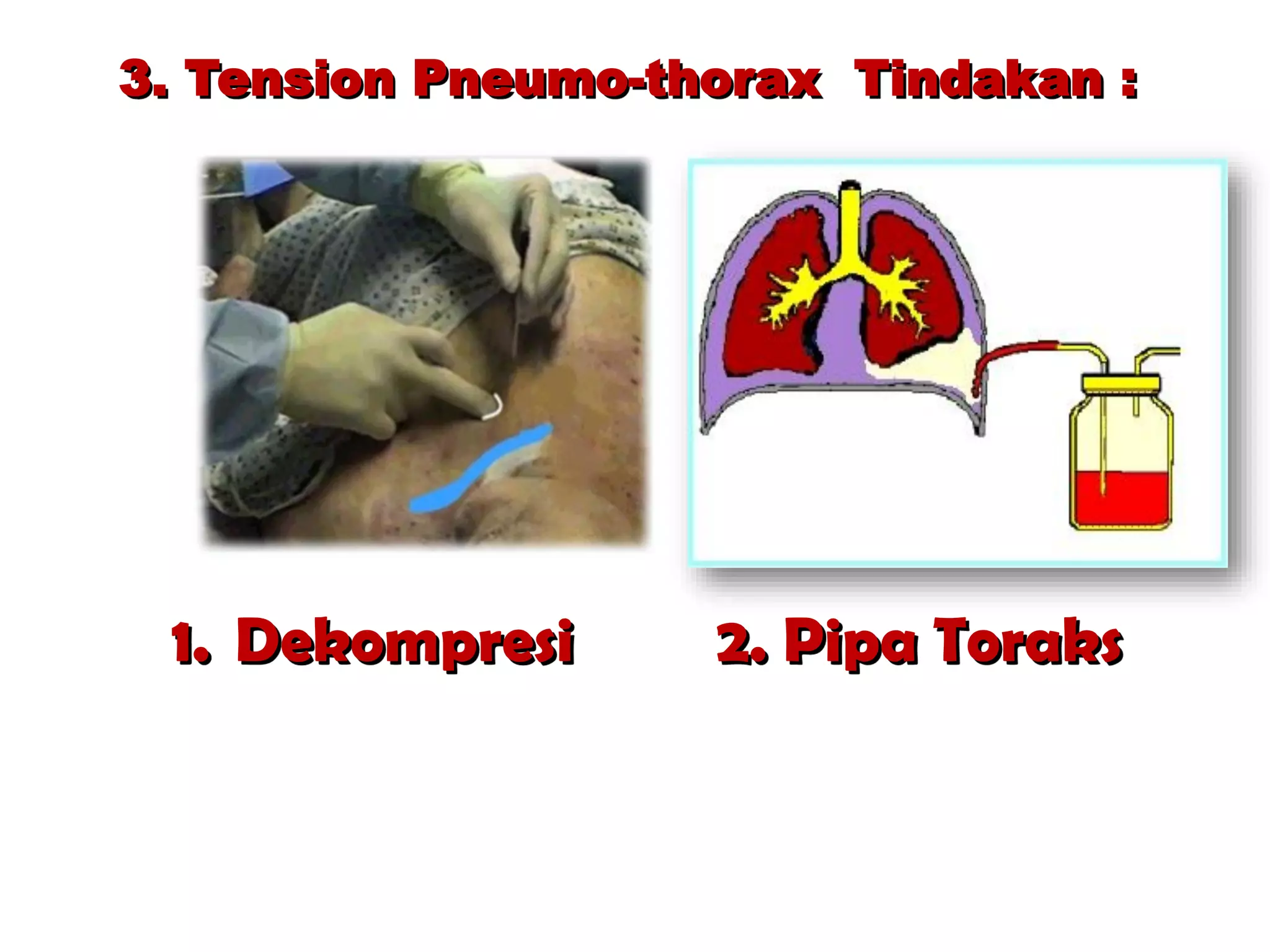 5 Trauma Thorak | PDF