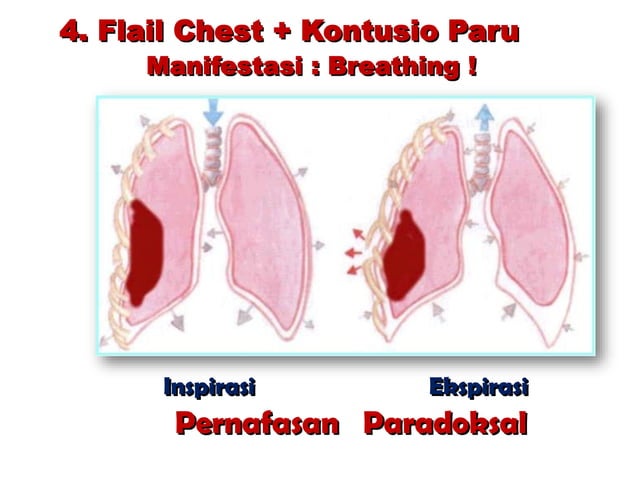 5 Trauma Thorak | PDF