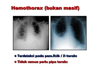5 Trauma Thorak | PDF