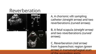 5 Ultrasound Artifacts in imaging2.pptx