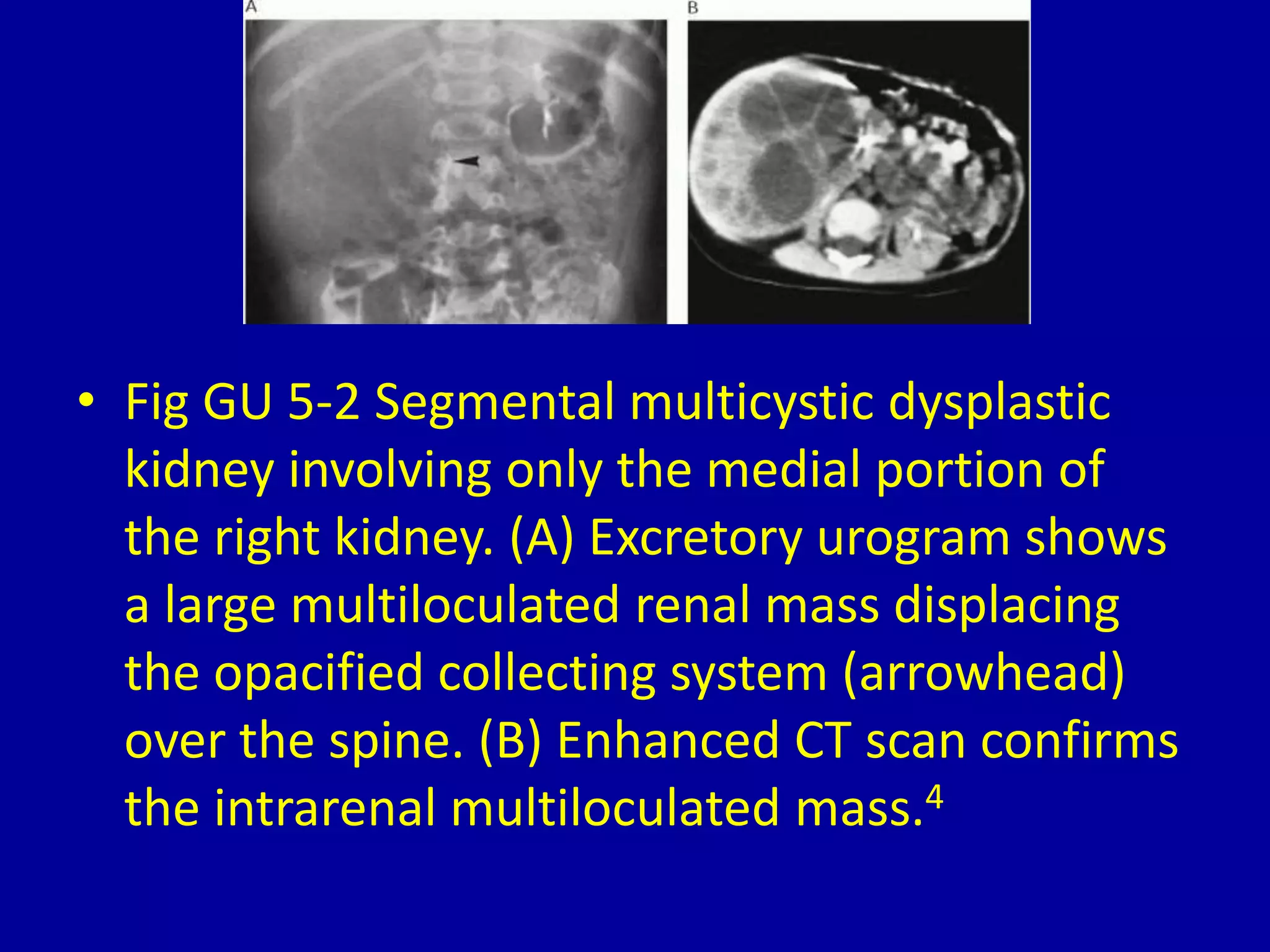 5 unilateral large, multilobulated kidney | PPTX