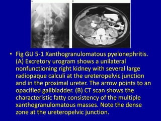 5 unilateral large, multilobulated kidney | PPT