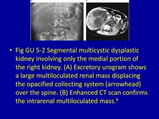 5 unilateral large, multilobulated kidney | PPT