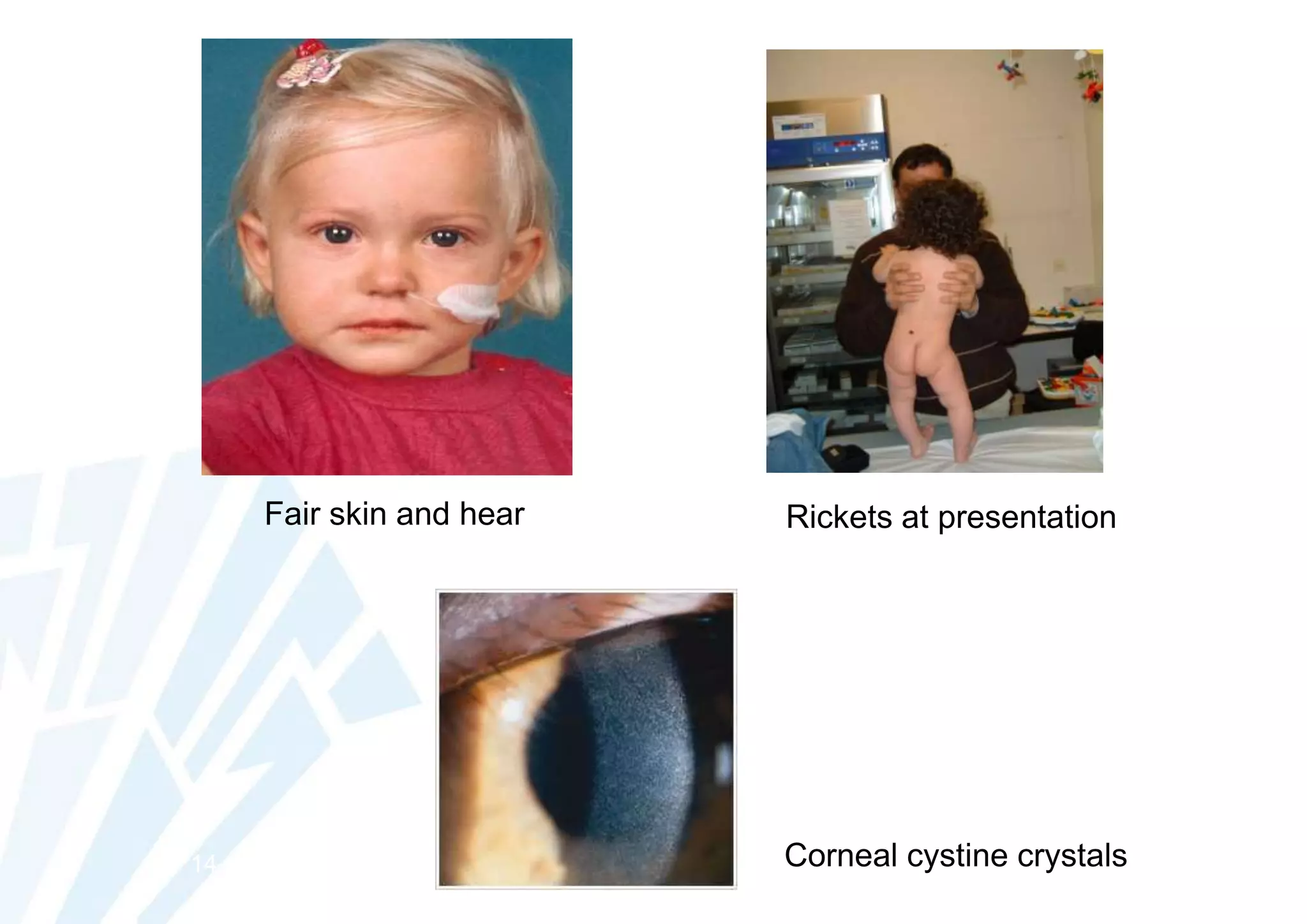6-1. Cystinosis. Elena Levtchenko (eng) | PPTX