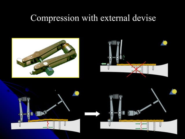 Plates-form and function | PPT | First Aid | Injuries