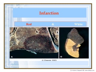 6. embolism; hemodynamic disordrs | PPT