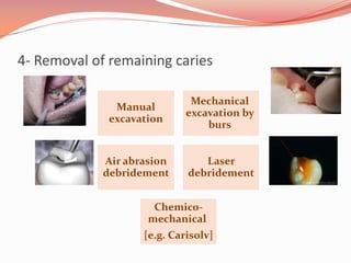 principles of cavity preparation | PDF
