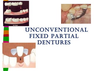 6.my unconventional fpd | PPT