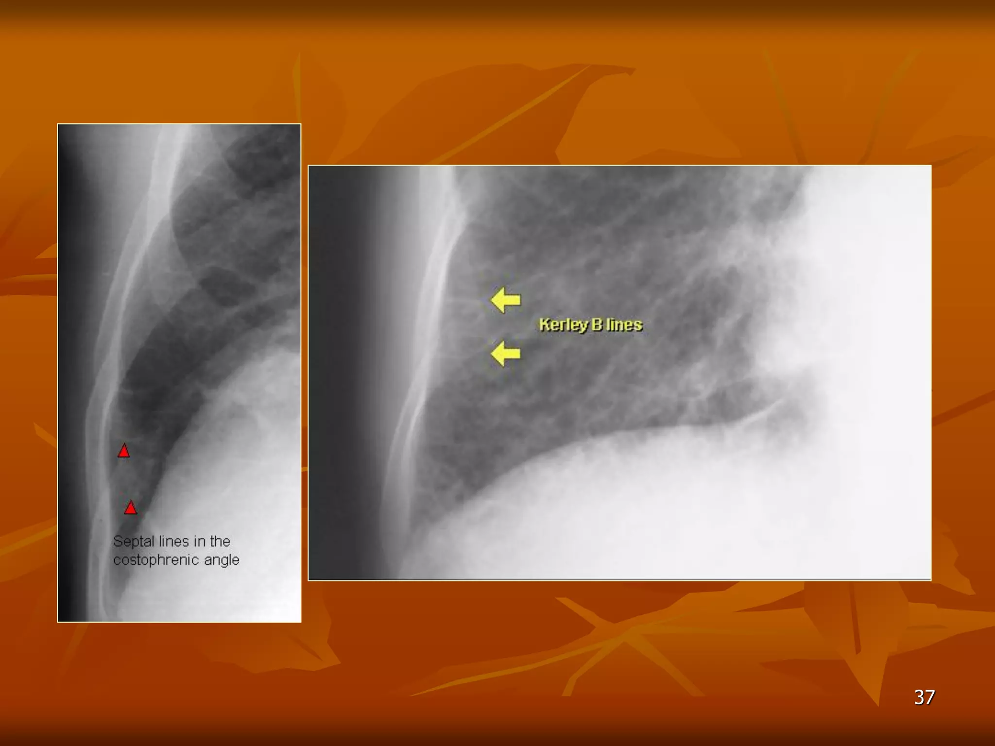 6.pulmonary edema and ards | PDF