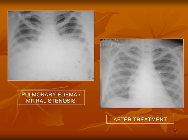 6.pulmonary edema and ards | PDF