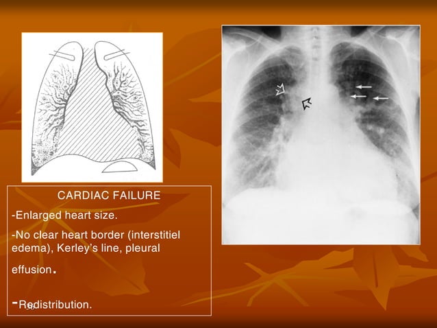 6.pulmonary edema and ards | PDF